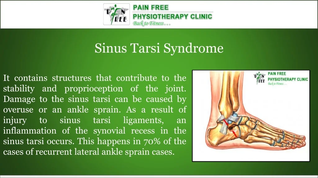 PPT - Sinus Tarsi Syndrome | Pain Free Physiotherapy PowerPoint ...