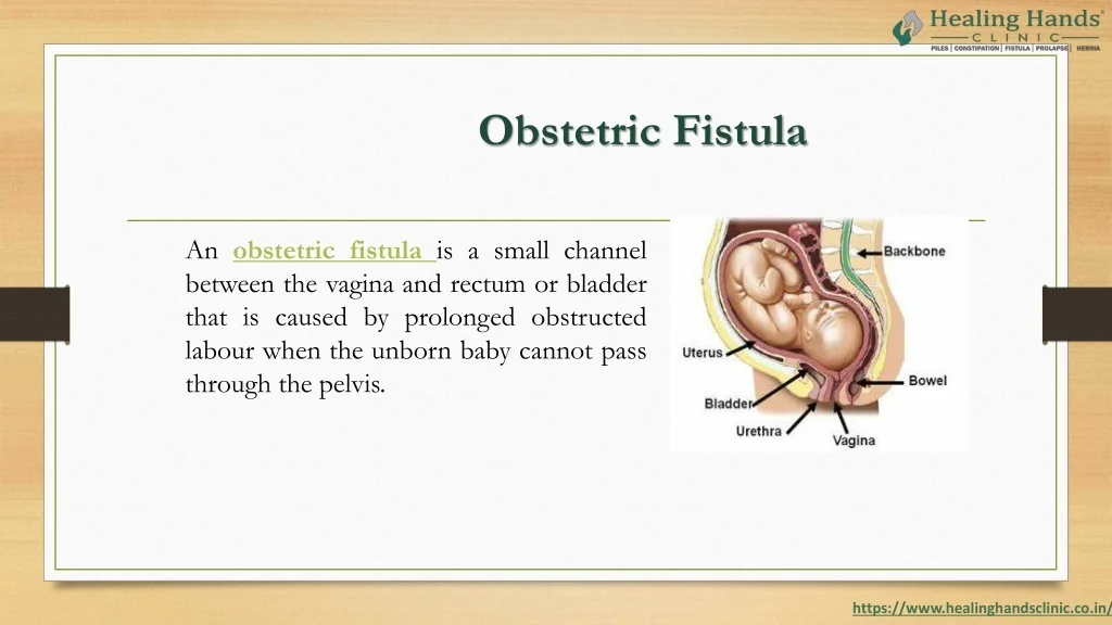 PPT - Obstetric fistula Cure And Treatment at Healing Hands Clinic ...
