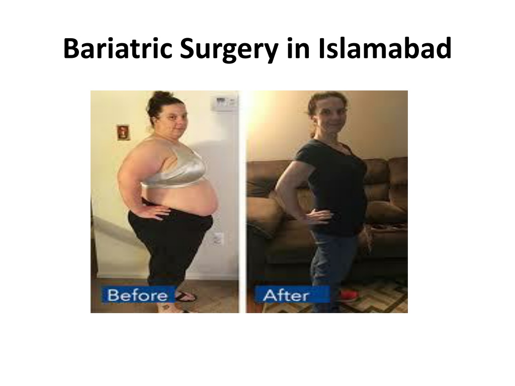 Ppt Bariatric Surgery In Islamabad Powerpoint Presentation Free