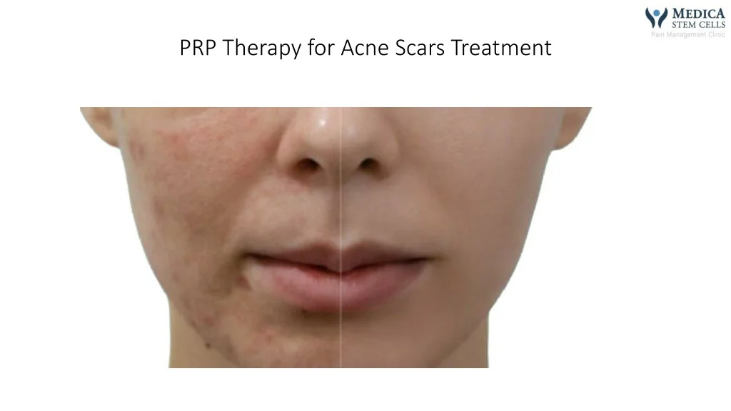 PPT - PRP Therapy for Acne Scars Treatment PowerPoint Presentation ...