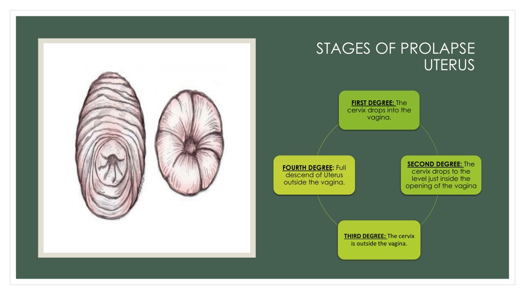 Ppt Herbal Treatment Of Uterus Prolapsed Powerpoint Presentation