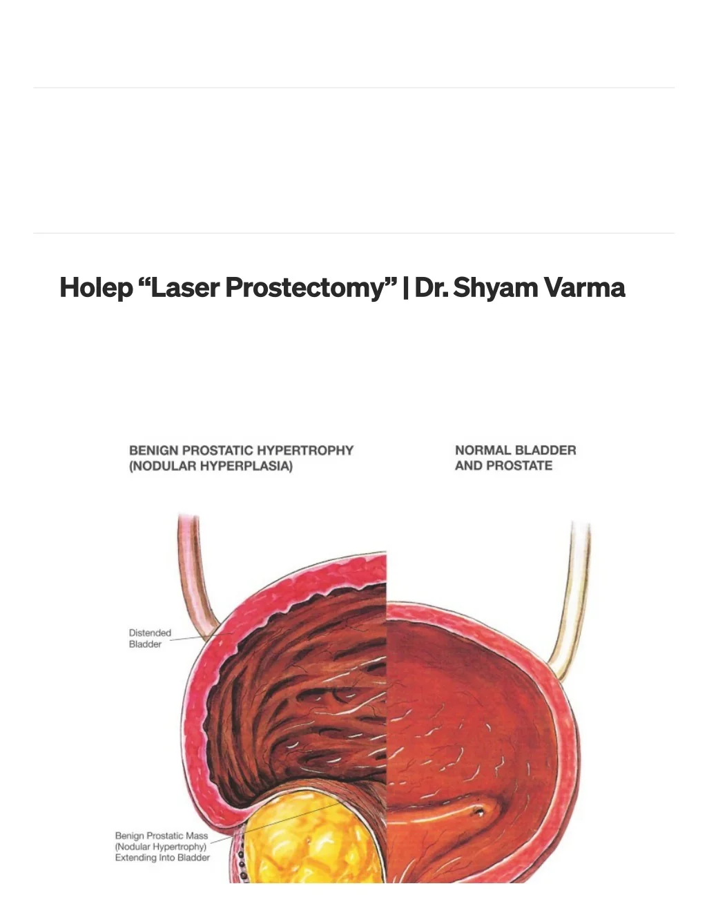 PPT - Holep Laser Prostectomy | Dr. Shyam Varma PowerPoint Presentation ...