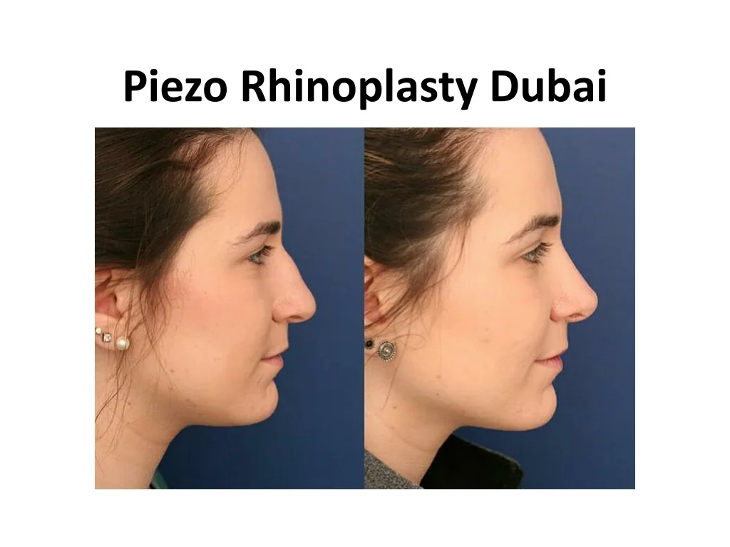 PPT - Piezo Rhinoplasty Dubai PowerPoint Presentation, free download ...