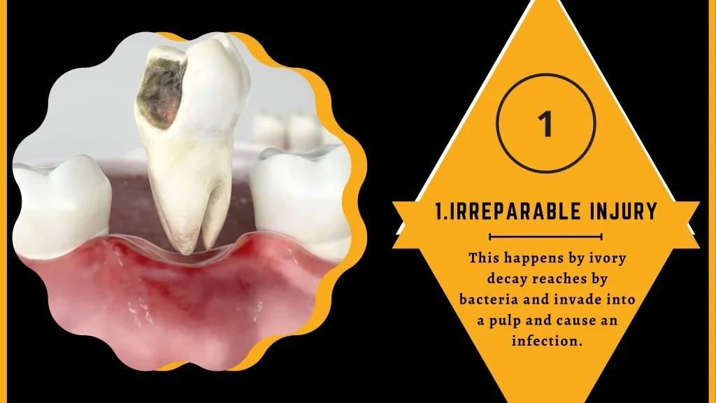 PPT - 5 Major Reasons For Tooth Extraction PowerPoint Presentation ...
