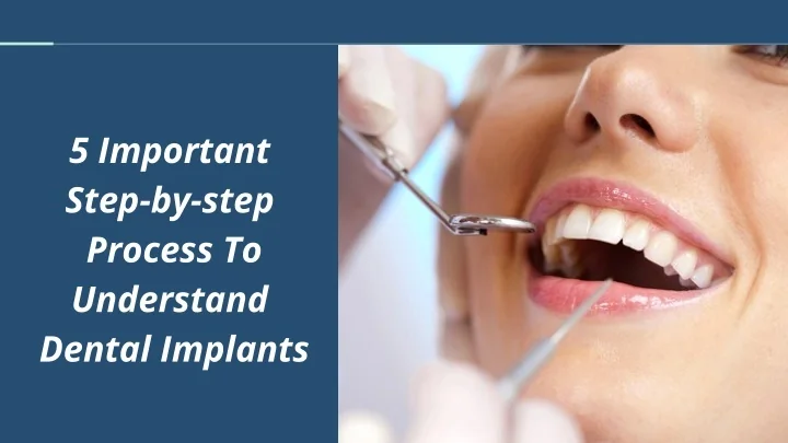 PPT - 5 Important Step-by-step Process To Understand Dental Implants ...