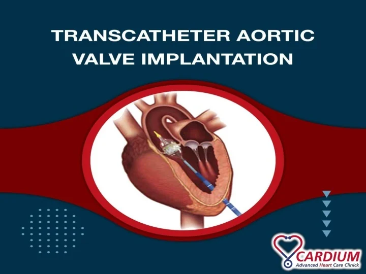 PPT - Transcatheter Aortic Valve Implantation (TAVI) | Surgical ...