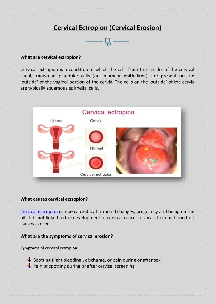 PPT - What are Cervical Ectropion? PowerPoint Presentation, free ...