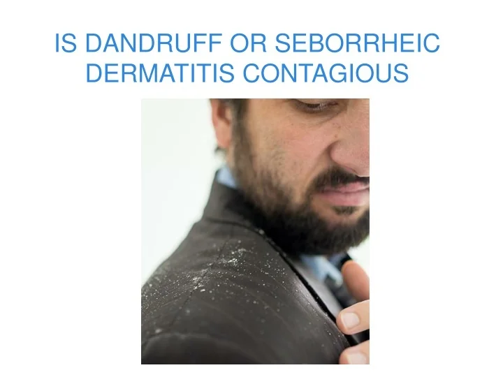 PPT - IS DANDRUFF OR SEBORRHEIC DERMATITIS CONTAGIOUS PowerPoint ...