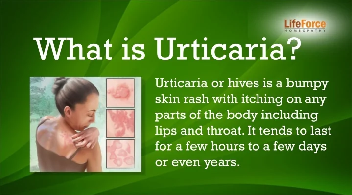 PPT - Best Urticaria Treatment at Life Force PowerPoint Presentation ...