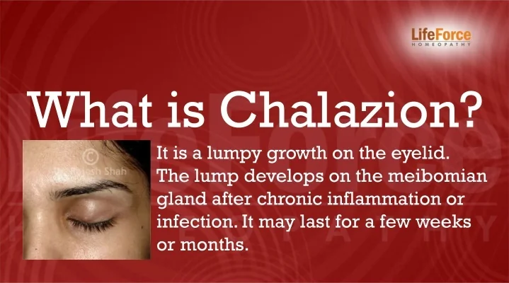 PPT - Everything about Chalazion Homeopathic Treatment and Diagnosis ...