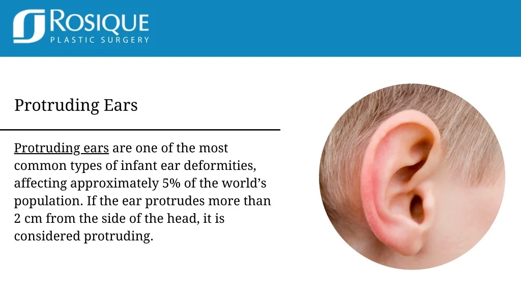 PPT - Get ear surgery by Dr Rodrigo Rosique! PowerPoint Presentation ...