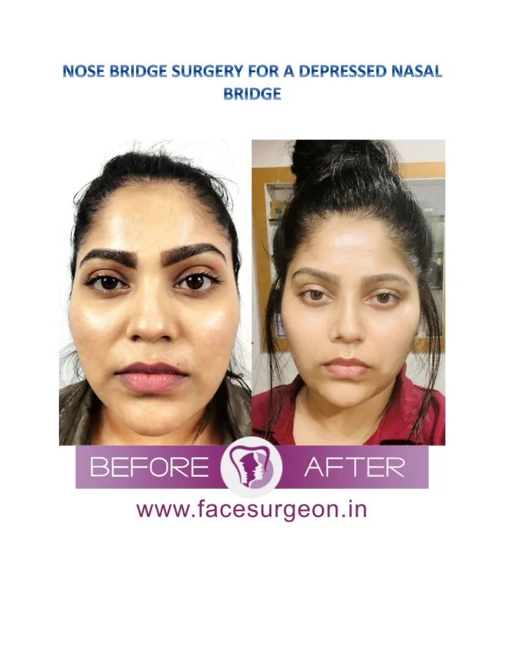 PPT - Nose Bridge Surgery for a depressed nasal bridge PowerPoint ...