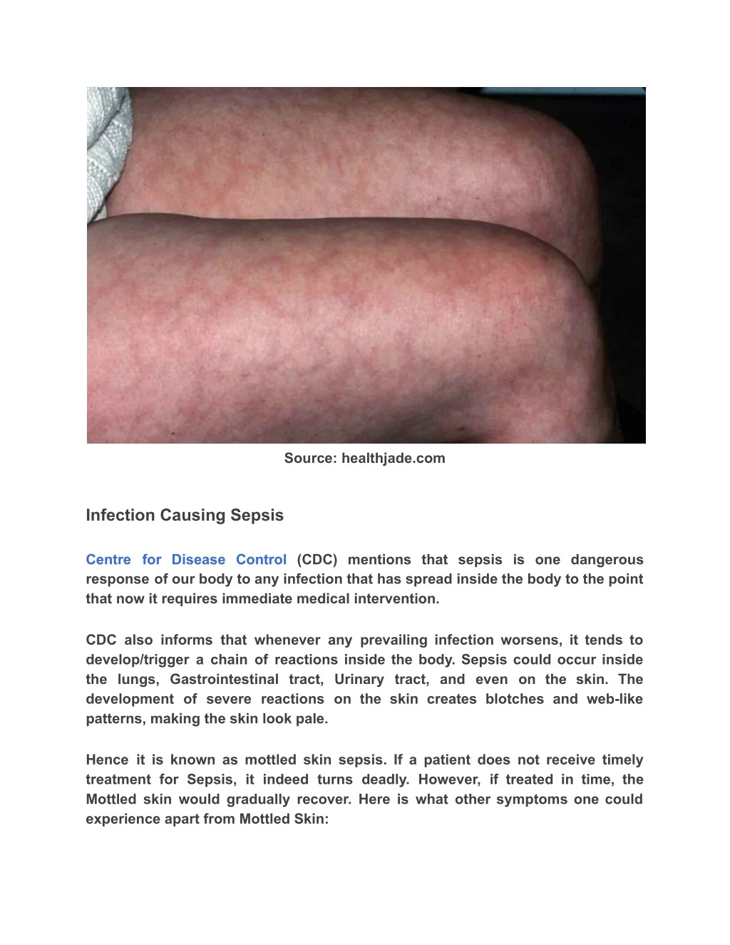 PPT - Mottled Skin: Treatment, Causes, Symptoms and More PowerPoint ...
