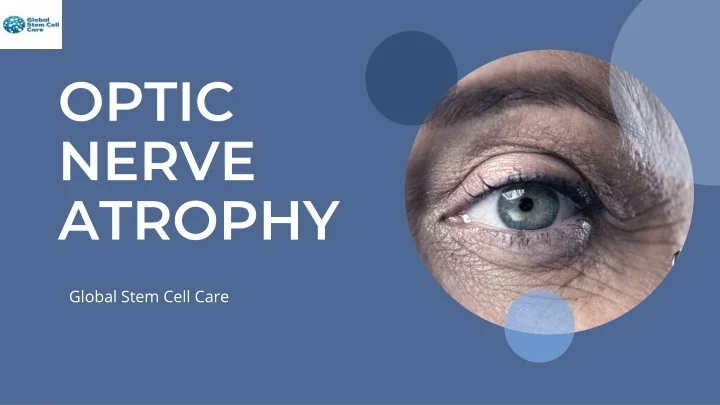 PPT - Stem Cell Therapy for Optic Nerve Atrophy PowerPoint Presentation ...