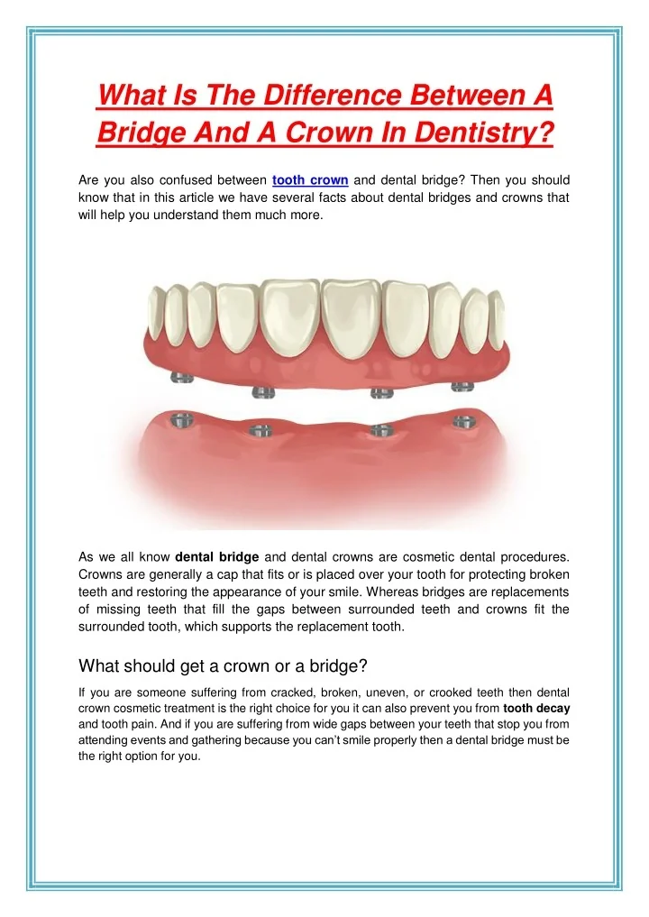 PPT - What Is The Difference Between A Bridge And A Crown In Dentistry ...