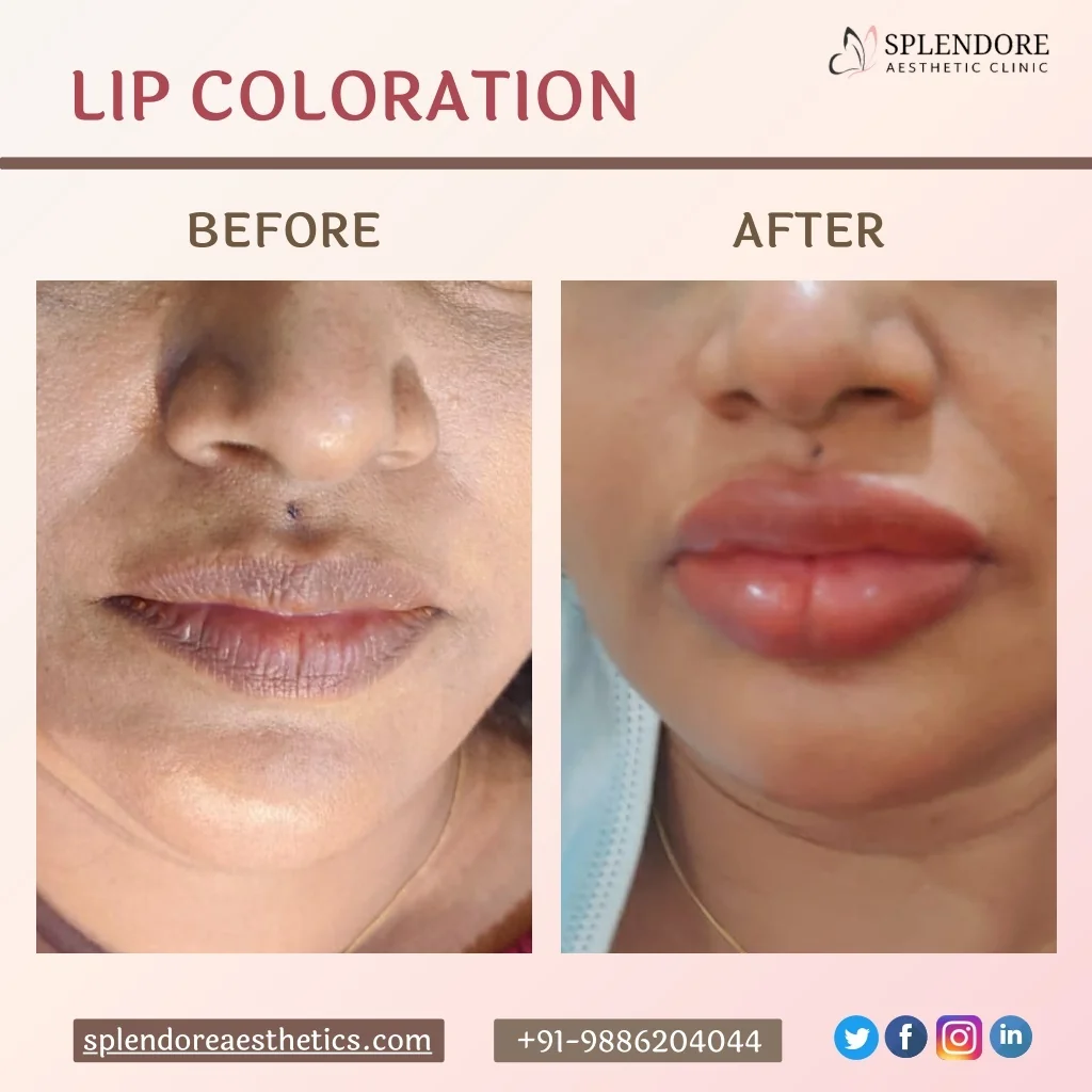 PPT - Lip Coloration Treatment at Aesthetic Skin Treatment in HSR ...