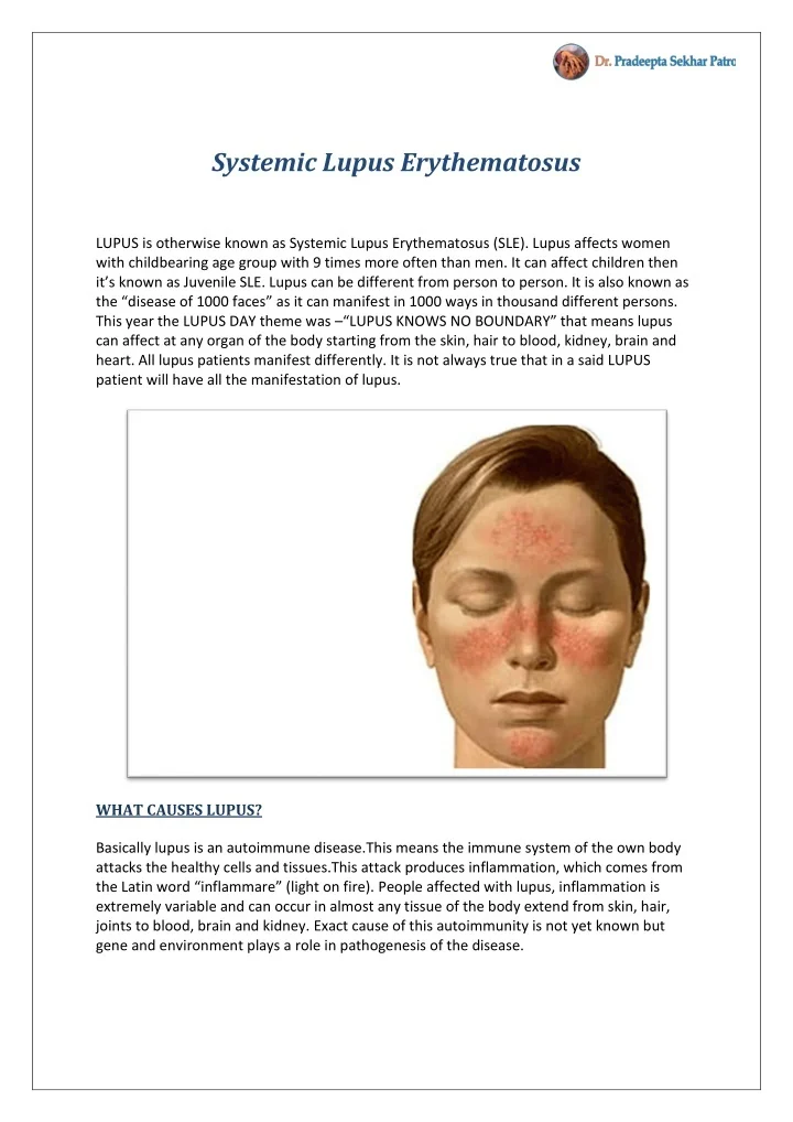 PPT - Systemic Lupus Erythematosus PowerPoint Presentation, free ...