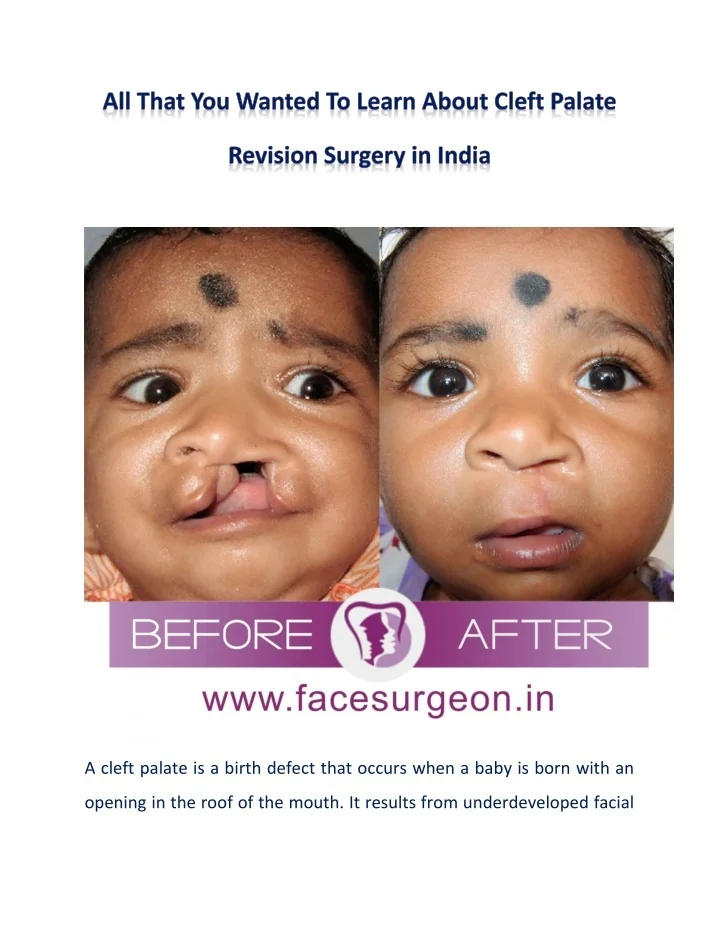 PPT - Cleft Palate Revision Surgery in India | All That You Wanted to ...