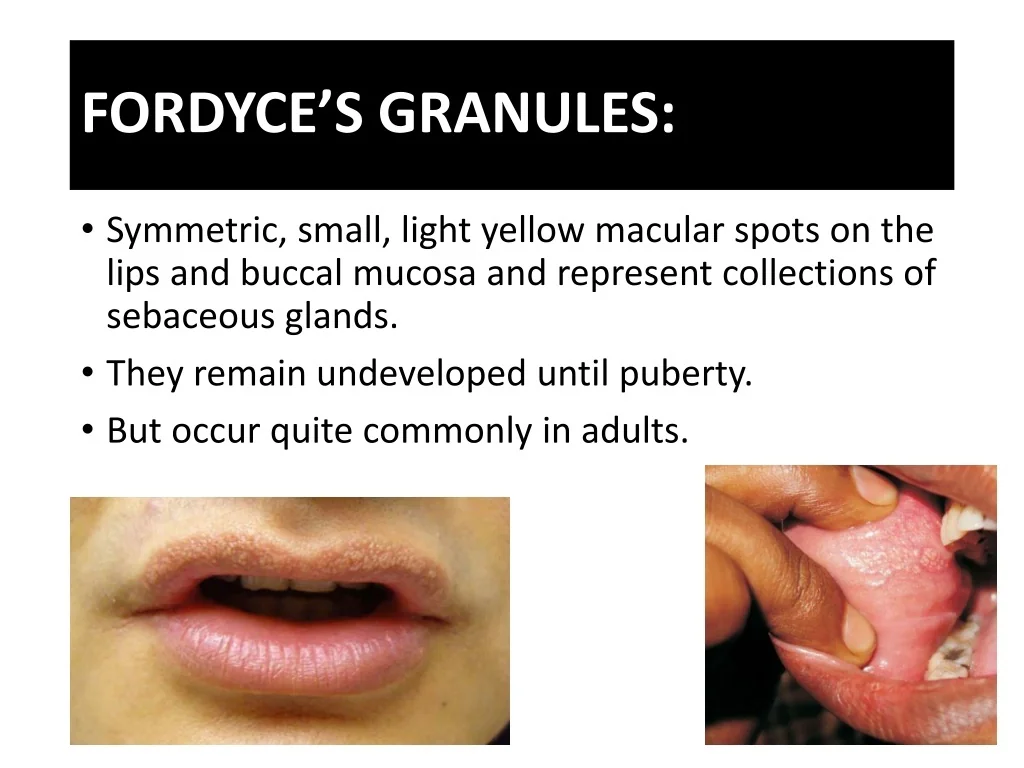 PPT - GI 01. Diseases Of The Oral Cavity PowerPoint Presentation, free ...