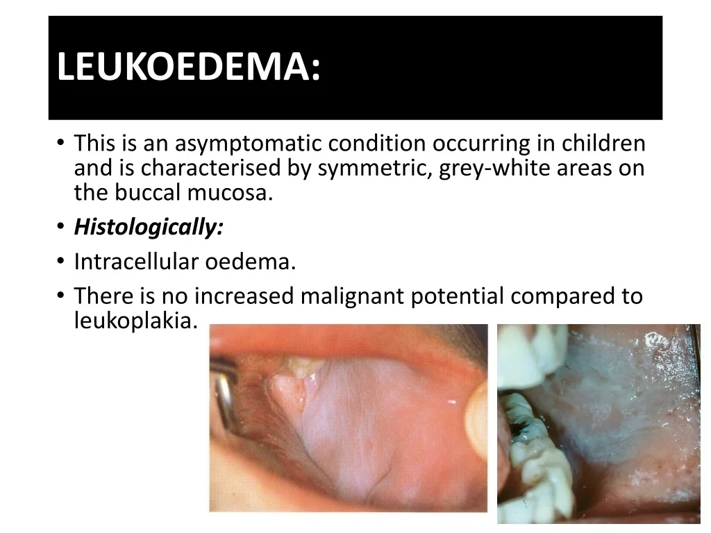 PPT - GI 01. Diseases Of The Oral Cavity PowerPoint Presentation, free ...