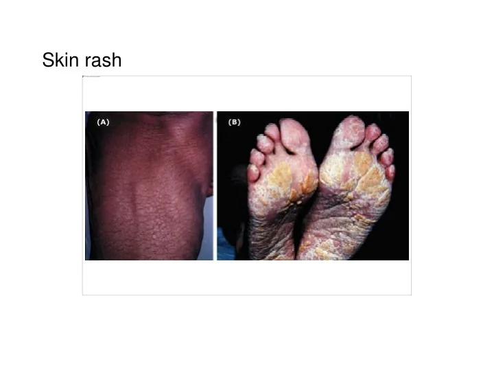 PPT - Skin rash PowerPoint Presentation, free download - ID:9370179