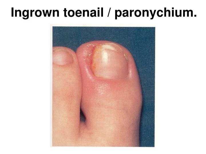 PPT - Ingrown toenail / paronychium. PowerPoint Presentation, free ...