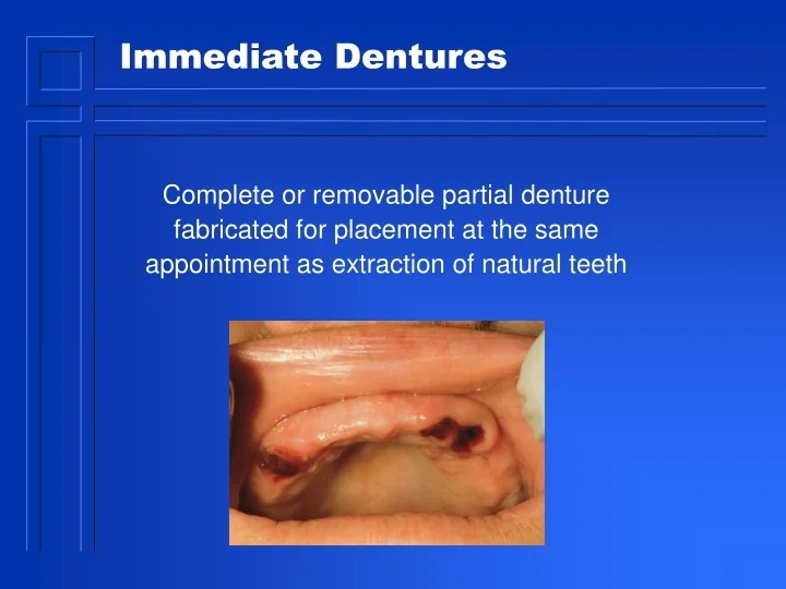 PPT - Immediate Dentures PowerPoint Presentation, free download - ID ...