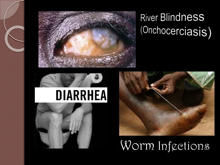 PPT - River Blindness (Onchocerciasis) PowerPoint Presentation, free ...