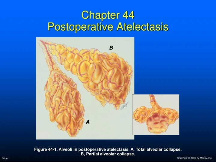PPT - Chapter 44 Postoperative Atelectasis PowerPoint Presentation ...