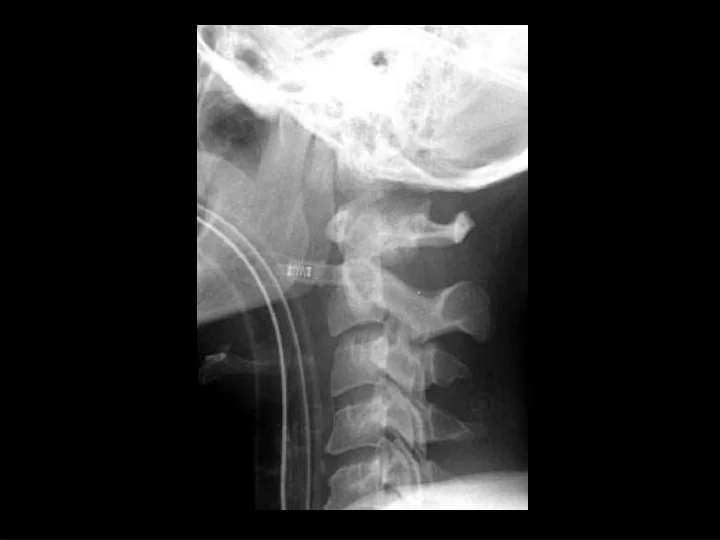 PPT - Atlanto-occipital dislocation PowerPoint Presentation, free ...