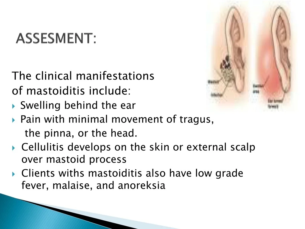 PPT Comprehensive Nursing Care For Mastoiditis Assessment Treatment