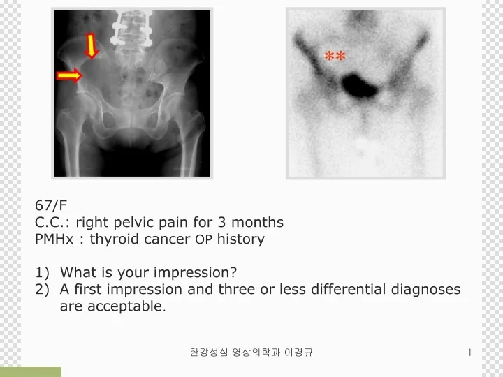 PPT - 67/F C.C.: right pelvic pain for 3 months PMHx : thyroid cancer ...