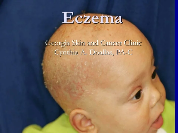 PPT - Eczema PowerPoint Presentation, free download - ID:9721625